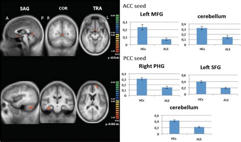 Seed Based Connectivity Analysis Decreased Functional Connectivity