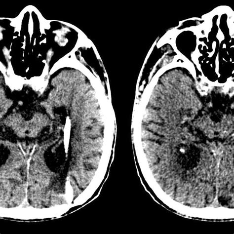 Mean Volumes Of The Segmented Intracranial Cerebrospinal Fluid Spaces