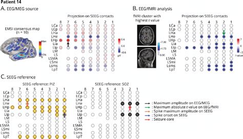 Example Of A Case With Left Posterior Insula Epilepsy Presenting Good Download Scientific