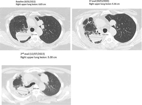 evidence of distant shrinkage of a leiomyosarcoma metastatic lung