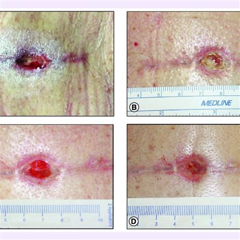 Fluorescent Micrographic Image Of Microvascular Tissue Graft Showing Download Scientific