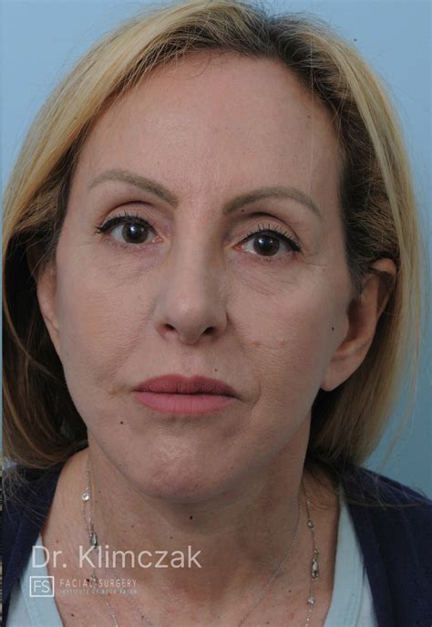 Facelift Patient 6 Facial Plastic Surgery Boca Raton