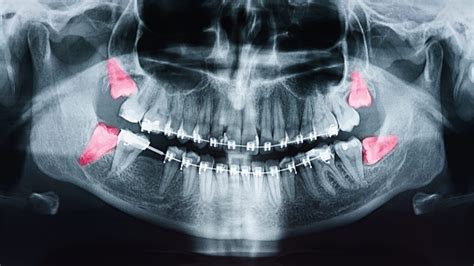 Wisdom Teeth X Rays Explained A Guide For Patients In The College