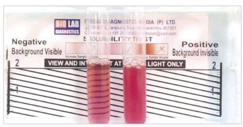 Labcorp Test Menu Sickle Cell At Frank Keith Blog