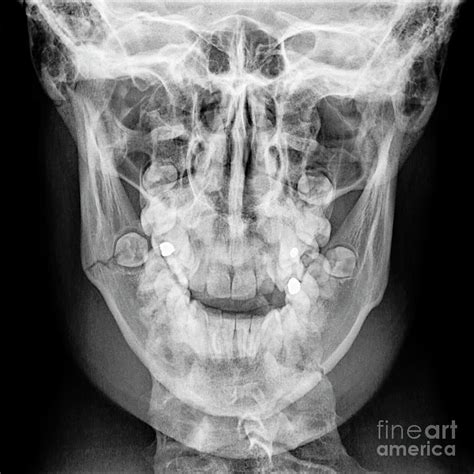 Jaw Bone Fracture By Science Photo Library