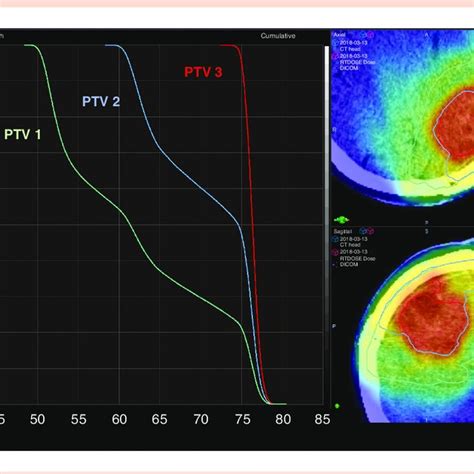 For The Patient In Figure 1 An Rt Dose Volume Histogram Is Shown On Download Scientific