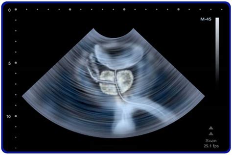 Biopsia de próstata en Culiacán Dr Efrén Gaxiola Pérez