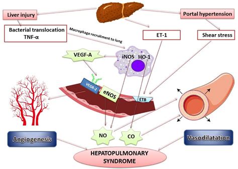 New Updates On Hepatopulmonary Syndrome A Comprehensive Review