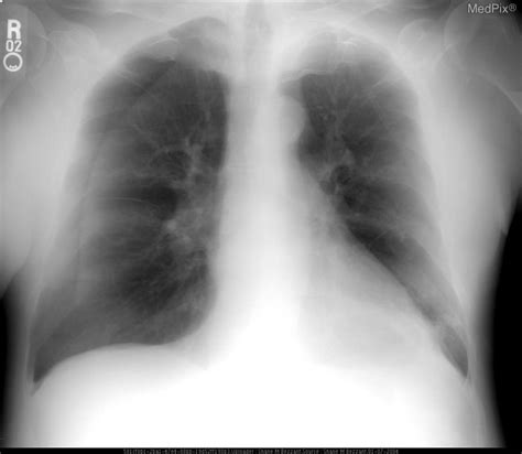 Apical Pneumothorax