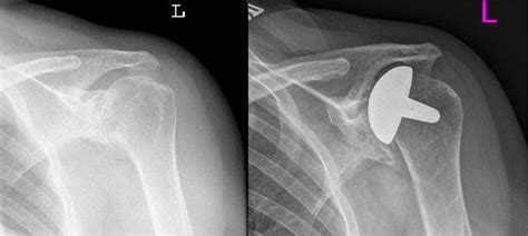 Example Of Severe Progression Of Glenoid Erosion After Csra Download Scientific Diagram