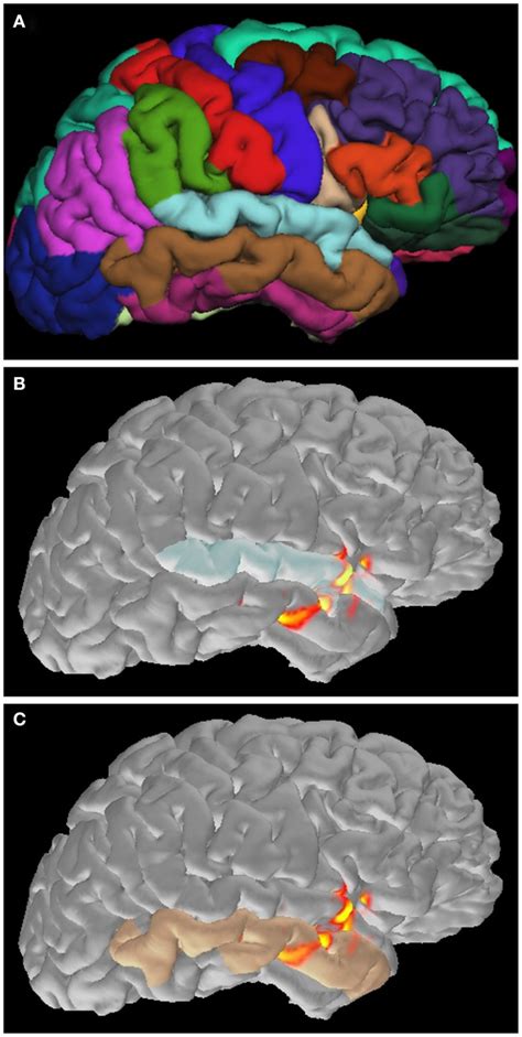 Application Of Cortical Parcellation Cortical Parcellation Is Obtained