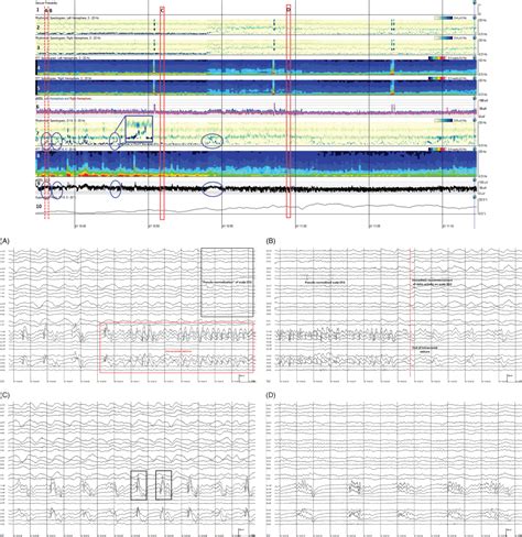 Quantitative Eeg Special Applications And Multimodal Monitoring Neupsy Key