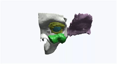 Improving Pre Operative Planning With Anatomical 3d Modeling Removing A Maxillary Sinus Tumor