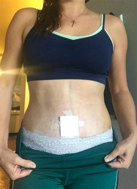 Pictures Swelling After Tummy Tuck Week By Week Recovery Momdot