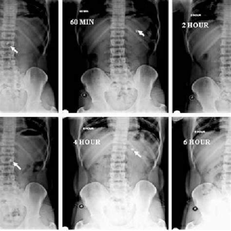 Intragastric Behavior Of The Baso 4 Loaded Floating Gelucire Matrices