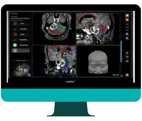 Cranial Navigation System At Best Price In Thrippunithura By Medbionix