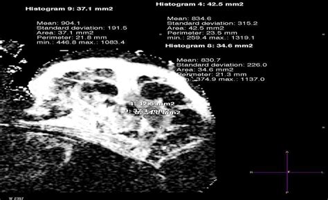 ADC Map Before Starting NAC Value 0 8 0 8 And 0 4 Download Scientific Diagram