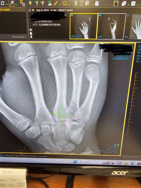 Will This Require Surgery Rorthopedic