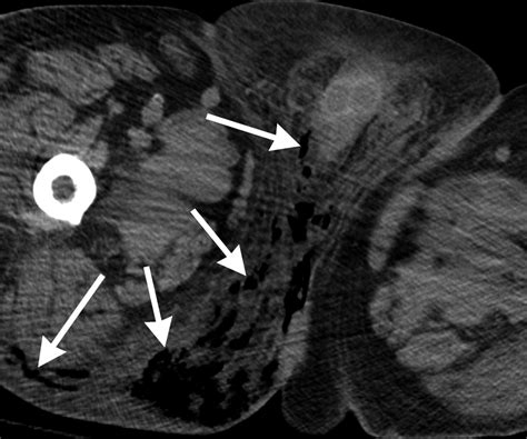 Fournier Gangrene Role Of Imagingradiographics