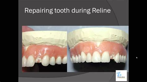 Reline Dentures Meaning At Shirl Wright Blog