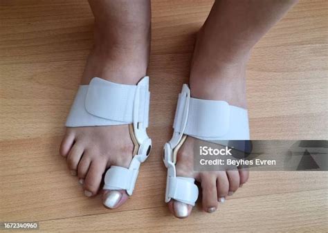 고통스러운 붉은 건막류와 부상 발을 가진 여성의 맨발 관절염에 대한 스톡 사진 및 기타 이미지 관절염 만성질환 발가락 Istock