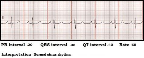 Float Nurse Ecg Rhythm Strip Quiz 81 Interval Measurements