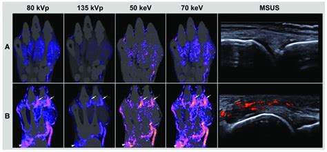 Imaging Examples Conventional Ct Subtraction For 80 And 135 Kvp