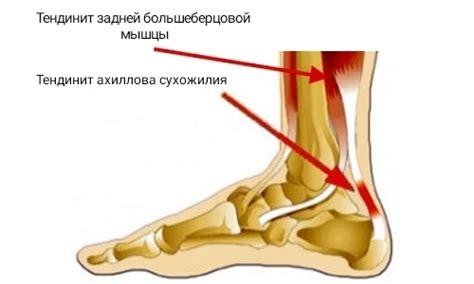 Заболевания сухожилий и связок — МЦ "Максимед"