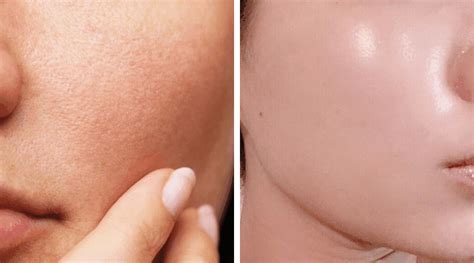 Cách Se Khít Lỗ Chân Lông Hiệu Quả Và An Toàn Tuyệt đối