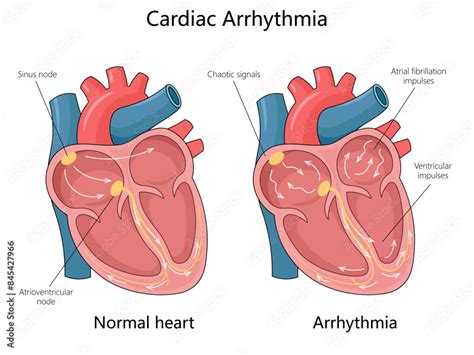 Normal Heart With Cardiac Arrhythmia Showing Sinus Node Chaotic
