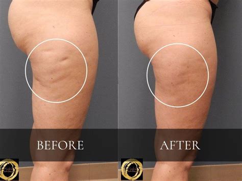 Before And After Cellulite