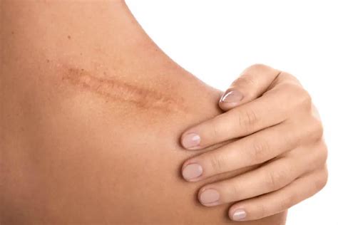 How Long Does A Cut Take To Heal Full Recovery Guide