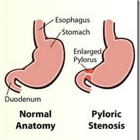 Pyloric Stenosis Pyloric Obstruction Stomach Outlet Obstruction Causes S S Treatment