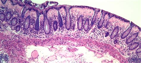 Endoscopy And Histopathology Intechopen