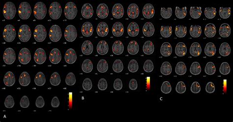 Awake Language Activation Examples A Patient 32 15 Years Old