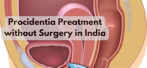 Procidentia Treatment Without Surgery In India