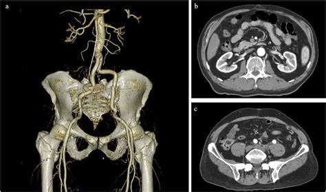 Two Year Follow Up Computed Tomography Ct Scan Of The Abdomen A Download Scientific Diagram