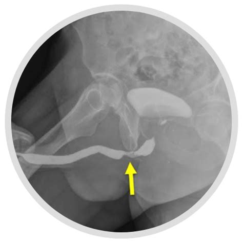 Urethral Stricture Treatment In Nashik Expert Urologist