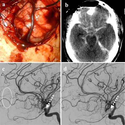 Intraoperative Event Immediately After Tumor Resection Showing A The