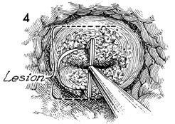 Conization Of The Cervix By The Loop Electrical Excision Procedure LEEP