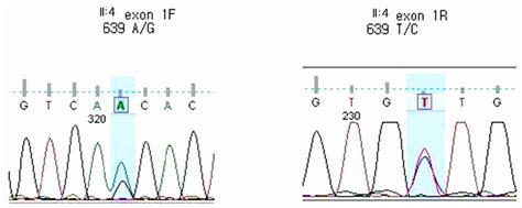 A Sequence Chromatogram Of The Proband Showing Heterozygous Mutation Download Scientific