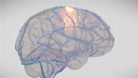 Synchron Vs Neuralink La Nueva Frontera De Los Implantes Cerebrales Implante Cirugia Synchron Vs Neuralink La Nueva Frontera De Los Implantes Cerebrales Implante Cirugia