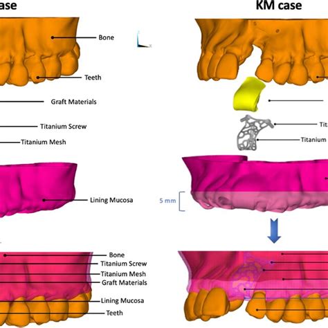 Finite Element Models Used In The Present Study Both Two Models Download Scientific Diagram
