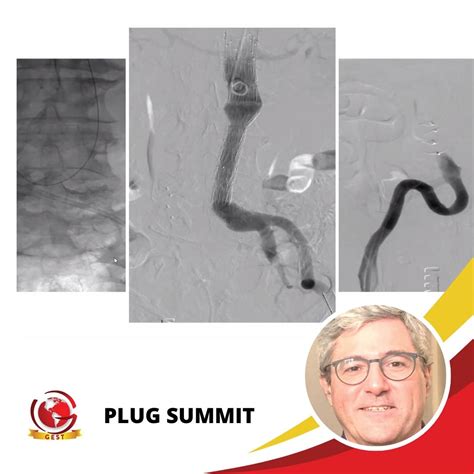 Global Embolization Symposium And Technologies Gest On Linkedin Interventionalradiology Ir