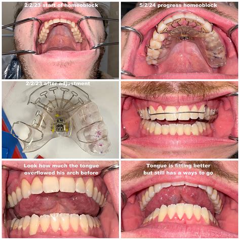 Homeoblock™ And Dna Appliance® Dentist In Arlington Va