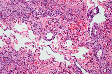 Ill Defined Macule On The Abdomen MDedge