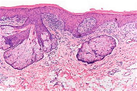 Diseases Of The Oral Mucosa And Soft Tissues General Aspects Pocket Dentistry