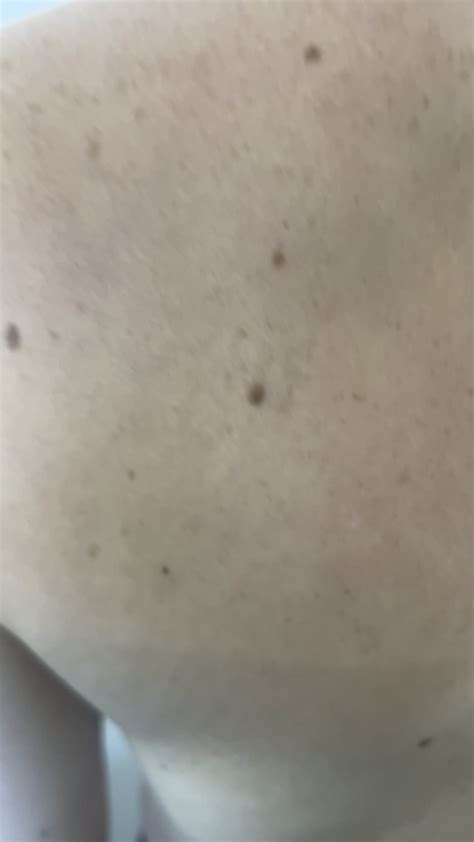 Zygomaticotemporal Nerve Damage