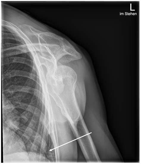 A Prospective Approach To Integration Of Ai Fracture Detection Software In Radiographs Into