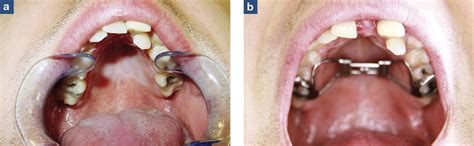 A Naturally Occurring Constricted Maxilla Pre Operative View B